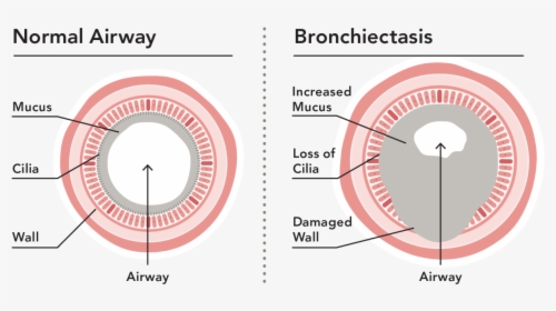 Bronchiectasis Loss Of Cilia, HD Png Download , Transparent Png Image ...